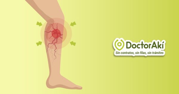 Flebitis: qué es, tipos, signos y causas | DoctorAkí