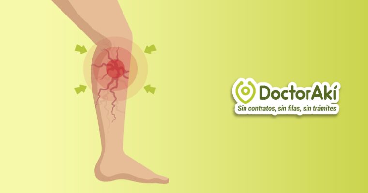 Flebitis: qué es, tipos, signos y causas | DoctorAkí